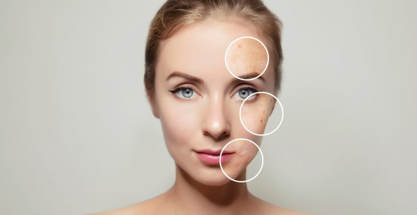 Acné : que signifie l'emplacement de nos boutons