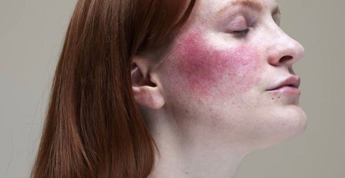 Elles posent au naturel pour sensibiliser à la rosacée